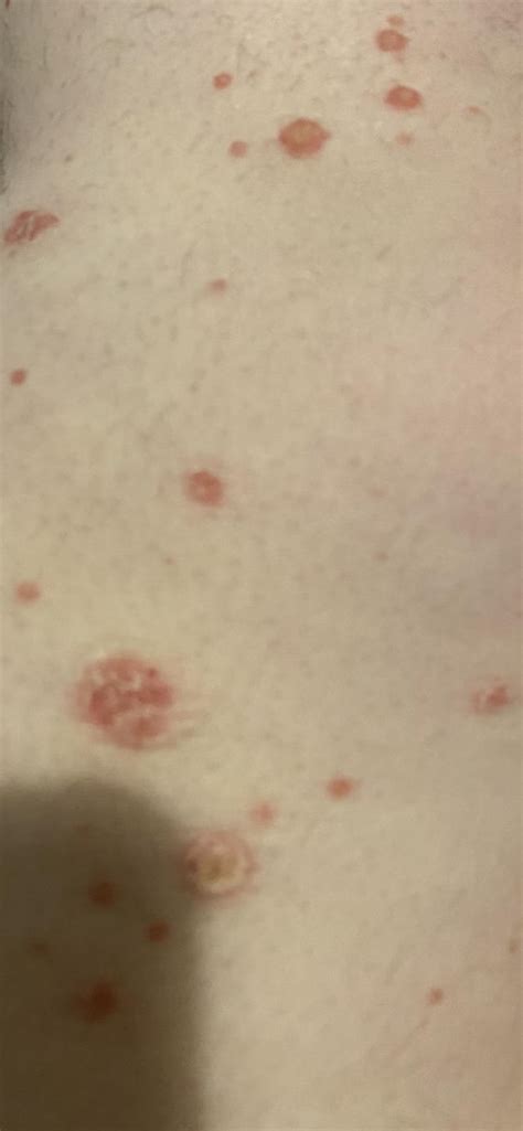 Dying My Hair Brought Back My Psoriasis Has This Happened To Anyone Else Rpsoriasis