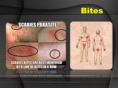 Predators Bed Bugs Scabies And More Pptx Infectious Diseases