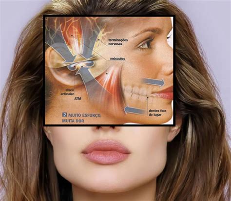 Moz Moda Desenvolvimento Do Músculo Masseter