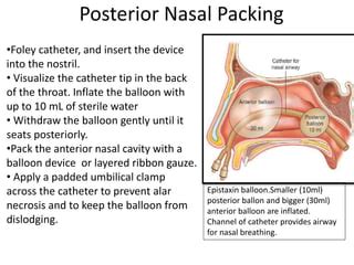 Nasal Fracture Pptx