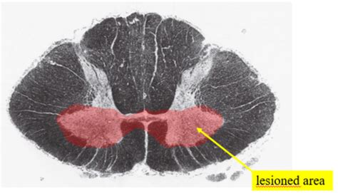 Neuro Final Spinal Cord And Brainstem Lesions Flashcards Quizlet