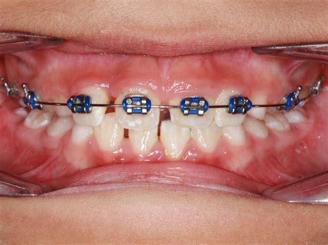 Before And After Metal Braces Photos