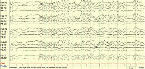 Polyspike And Wave