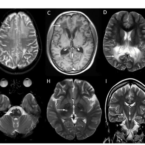 Figure Neuroimaging Spectrum In X Ald A E And Amn F J Mri Brain Tt