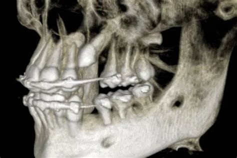 Impacted Canine Everything You Need To Know Calgary Ab