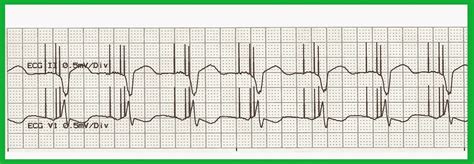 Float Nurse Practice Ekg Rhythm Strips 211