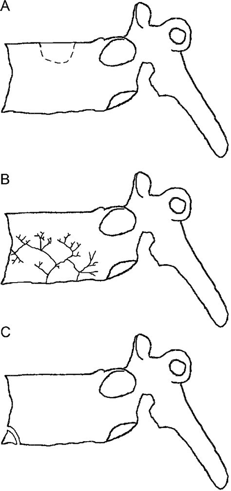 Thoracic Vertebrae Lateral View Showing A Schmorls Node B Type Download Scientific
