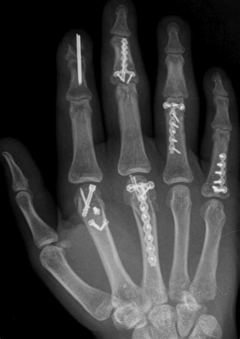 Fractures Dislocations And Ligamentous Injuries Of The Hand And Wrist