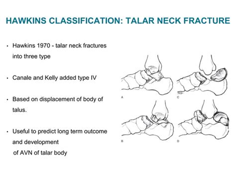 Talus Fracture Treatment Algorithm Ppt