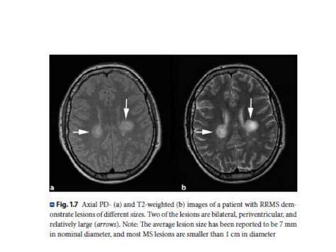 Radiology Of Multiple Sclerosis Pptx