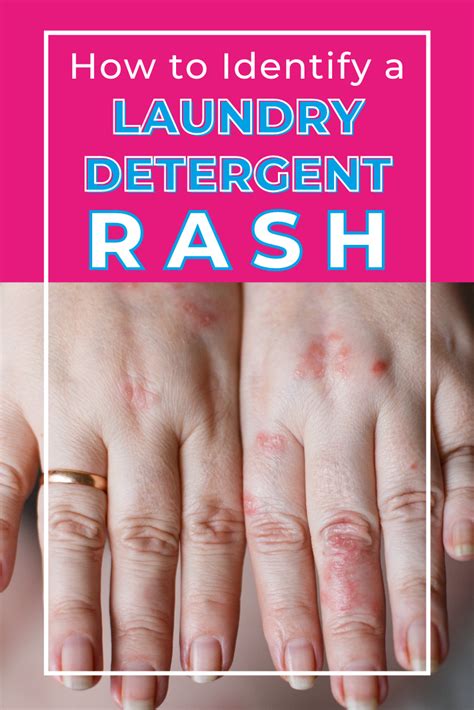 Laundry Detergent Rash 7 Ways To Treat It Artofit