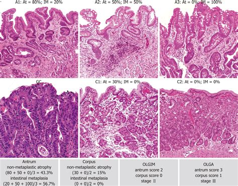Intestinal Metaplazi Pdf