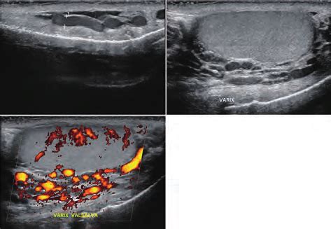 Varicocele Ultrasound