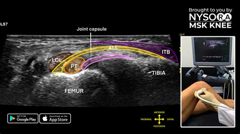 Msk Tip Of The Week For Scanning The Oblique Popliteal Ligament