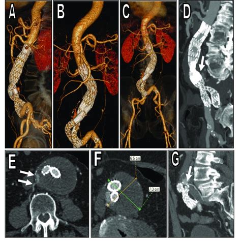Pdf Follow Up Ct Angiography Post Evar Endoleaks Detection Classification And Management