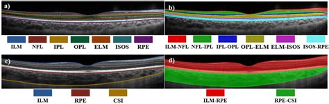 Example Of An Oct Image From The Retinal Dataset Ab And Choroidal