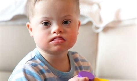 Yenidoğan Bebeklerde Down Sendromu Belirtileri SaĞlik Dünya Çocuk Gazetesi