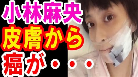 腫瘍皮膚を突き破る 皮膚から癌が飛び出す画像 Aqavpe