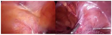 Reaching The Mesh Arms With The Subperitoneal From The Modified Port