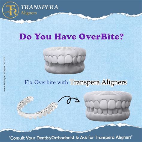 How Clear Aligners Can Fix Overbite Transpera Aligners Posted On The