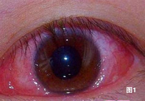 过敏性结膜炎 Allergicconjunctivitis，ac 过敏性结膜炎 介绍 发病原因 好大夫在线