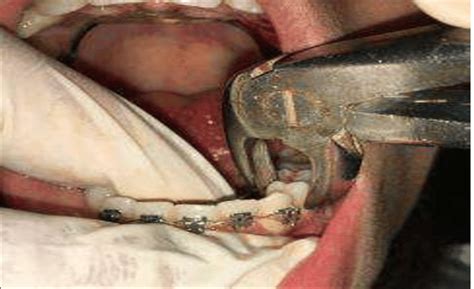 Lower Left Premolar Extracted Using Conventional Forcep Download