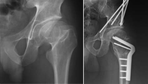 Hip Replacement St Louis Mo Periacetabular Osteotomy Pao For