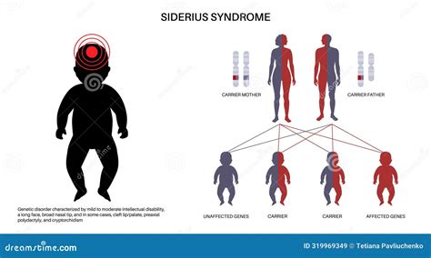 Siderius Syndrome Scheme Stock Vector Illustration Of Linked 319969349