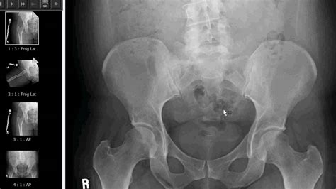 Normal Hip Xray Review Steamtaste Normal Hip Xray Review Steamtaste