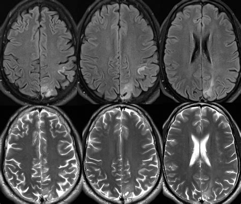What Is The Most Likely Diagnosis In This 40 Yo M With No Significant