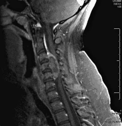 Vascularized Bone Grafts In Spine Surgery Clinical Tree