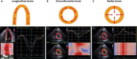 Two Dimensional Echocardiographic Assessment Of Myocardial Strain Important Echocardiographic