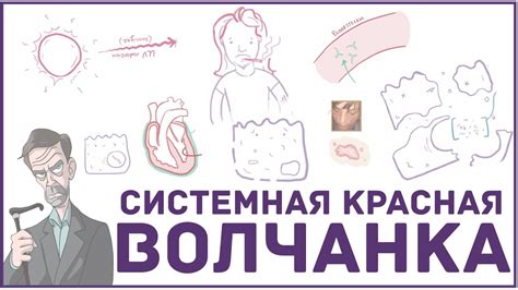Системная красная волчанка причины симптомы диагноз и патология Youtube