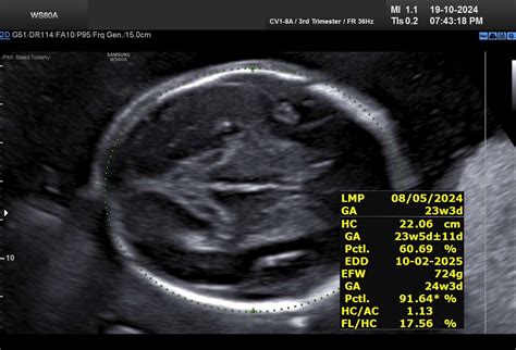 How To Perform Accurate Fetal Biometry Key Measurements And Techniques