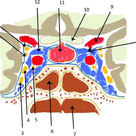 Cta Head Consistent With Invasive Fungal Sinusitis Involving The Right Download Scientific