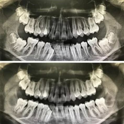 Wisdom Tooth Extraction Understanding The Healing Process