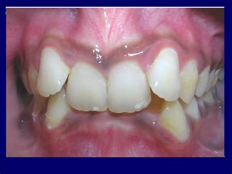 Classification Of Normal Occlusion And Malocclusion Ppt