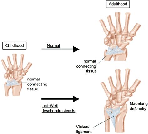 Schematic Representation Of The Vickers Ligament That Tethers The