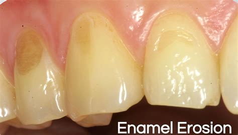 Enamel Erosion Dental Implant Center