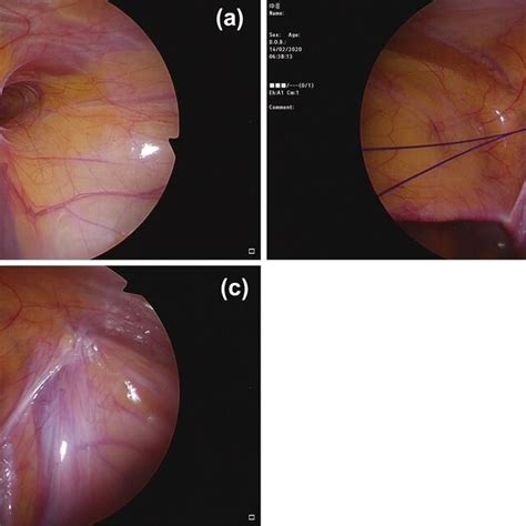 Right Indirect Inguinal Hernia A The Loop Which Contains All The