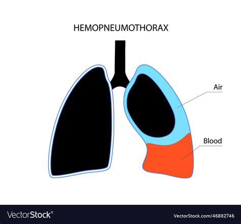 Hemopneumothorax Medical Poster Royalty Free Vector Image