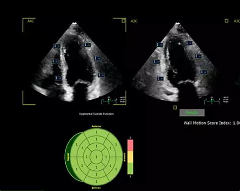 Ultrasound Ai Solutions Products And Services Philips