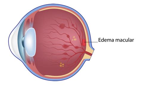 Edema Macular Qué Es Causas Y Tratamientos Oftalclinic