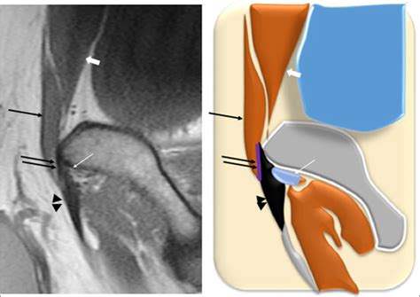 Patterns Of Injuries In Sports Groin Review And Pictorial Essay