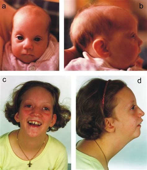 Dysmorphic Feature Alchetron The Free Social Encyclopedia