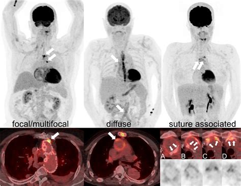 18f Fluorodeoxyglucose Uptake Patterns In Positron Emission Tomography