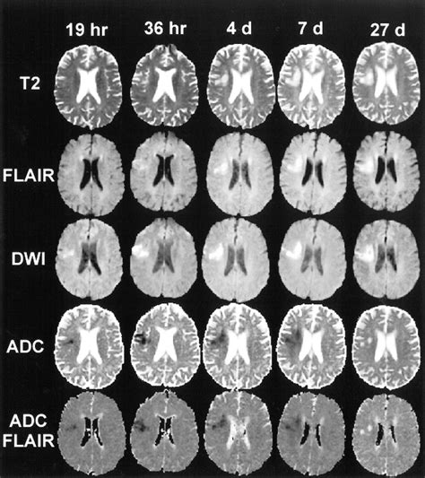 Small Strokes On Mri An Mri Based Ischemic Stroke Classification Zryt