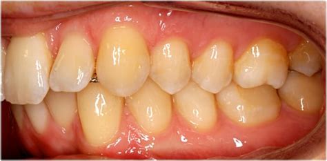Root Torque Of Tooth 32 Morita