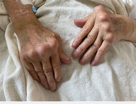 Ulnar Deviation Of Metacarpophalangeal Joints With Swanneck Deformity