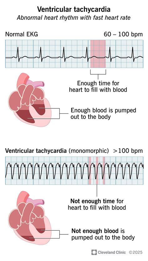 Paroxysmal Ventricular Tachycardia Atrial Rhythms Bmhtele